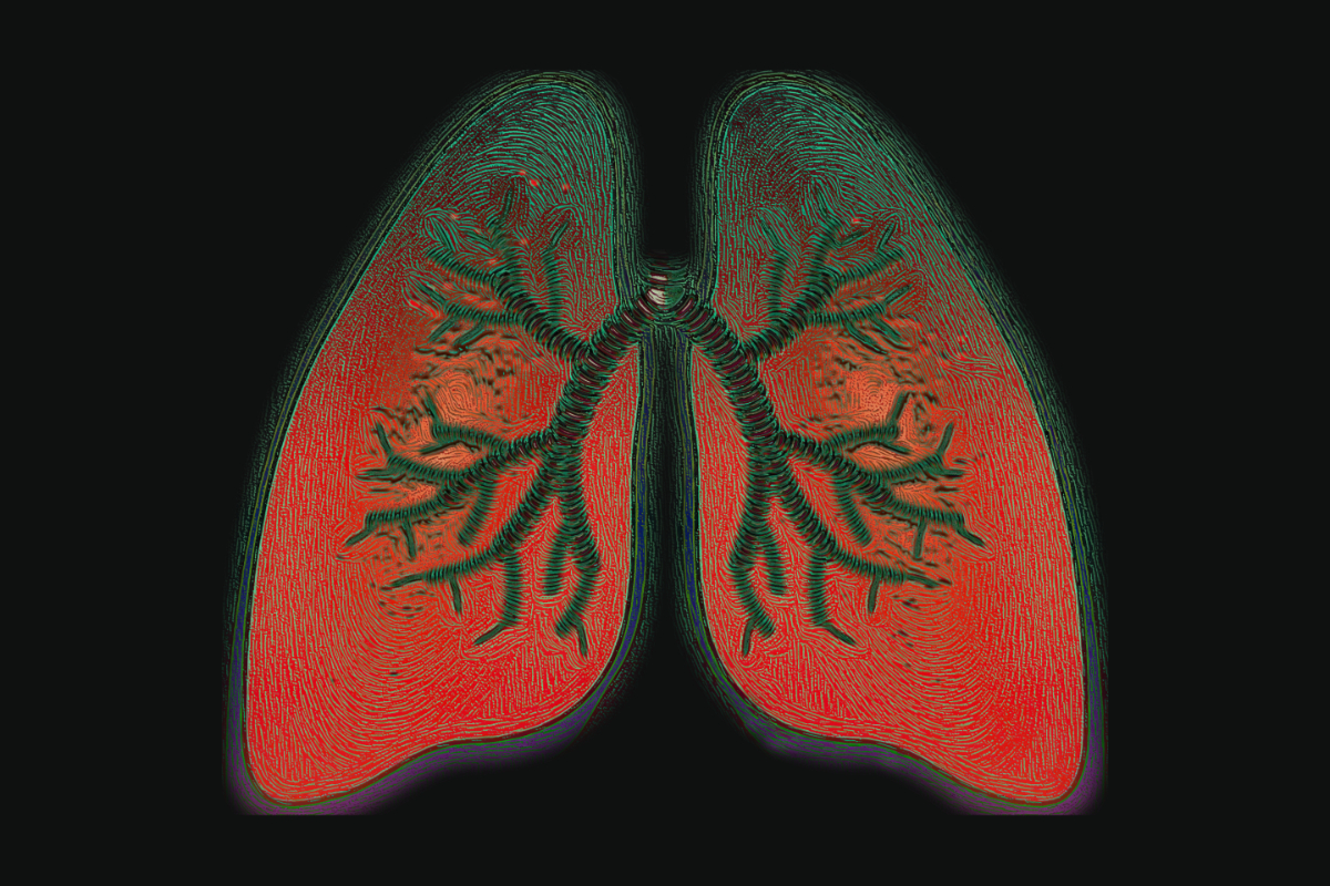 AstraZeneca and Amgen's TEZSPIRE® Approved for Self-administration in ...